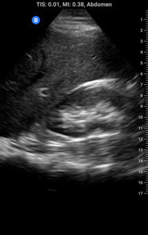 The Basics – Toronto Internal Medicine POCUS