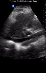 IVC Ultrasound – Toronto Internal Medicine POCUS