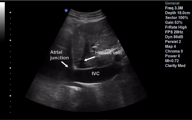IVC Ultrasound – Toronto Internal Medicine POCUS