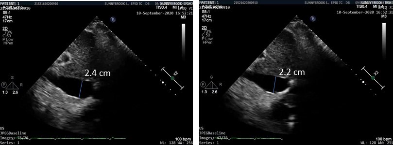 IVC Ultrasound – Toronto Internal Medicine POCUS