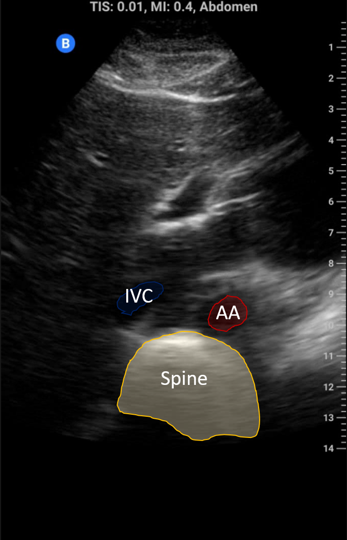 IVC Ultrasound – Toronto Internal Medicine POCUS