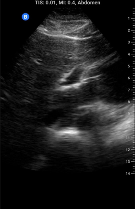 IVC Ultrasound – Toronto Internal Medicine POCUS