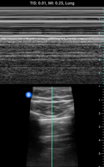 The Basics – Toronto Internal Medicine POCUS