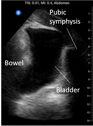 Abdominal Free Fluid Ultrasound – Toronto Internal Medicine POCUS