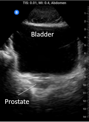Abdominal Free Fluid Ultrasound – Toronto Internal Medicine POCUS