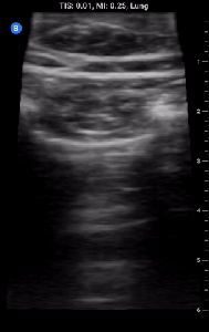 Lung Ultrasound – Toronto Internal Medicine POCUS