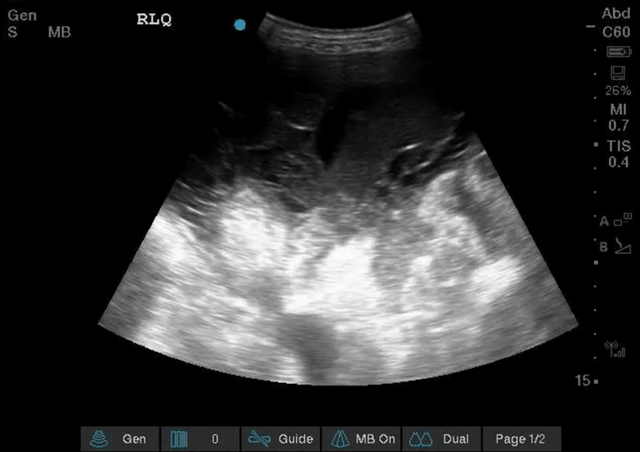Abdominal Free Fluid Ultrasound – Toronto Internal Medicine POCUS