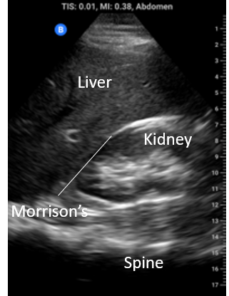 Abdominal Free Fluid Ultrasound – Toronto Internal Medicine POCUS
