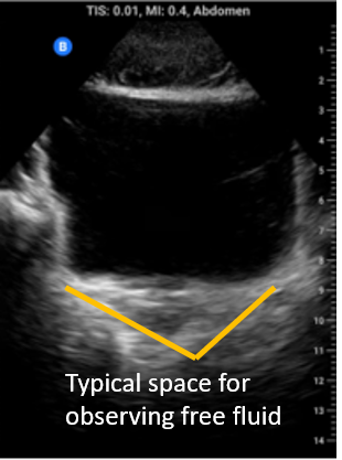 Abdominal Free Fluid Ultrasound – Toronto Internal Medicine POCUS