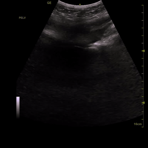 Abdominal Free Fluid Ultrasound – Toronto Internal Medicine POCUS