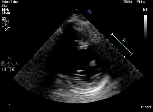 Cardiac Views – Toronto Internal Medicine POCUS