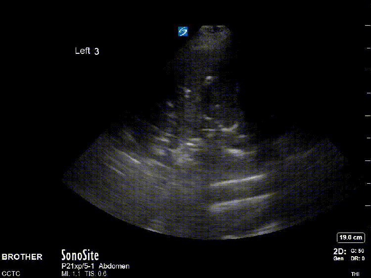 Lung Ultrasound – Toronto Internal Medicine POCUS