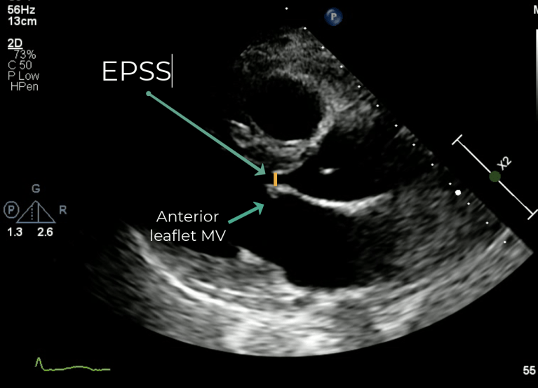 Left Ventricular Function – Toronto Internal Medicine POCUS