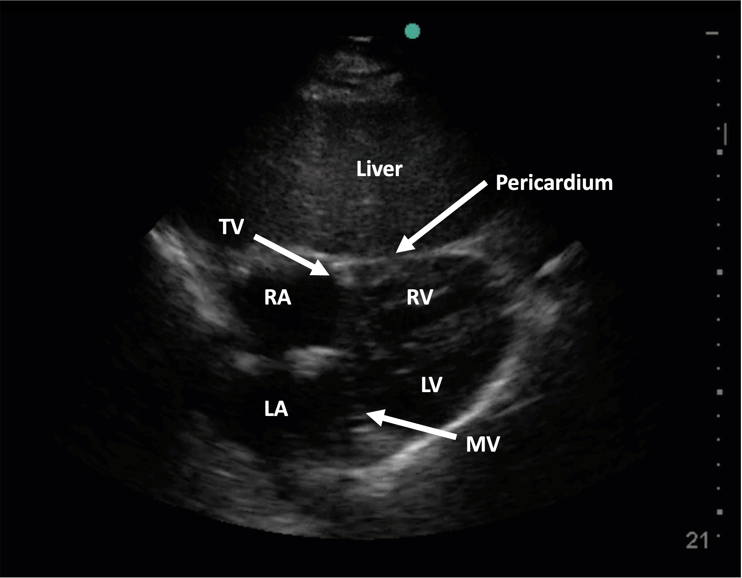 Cardiac Views – Toronto Internal Medicine POCUS