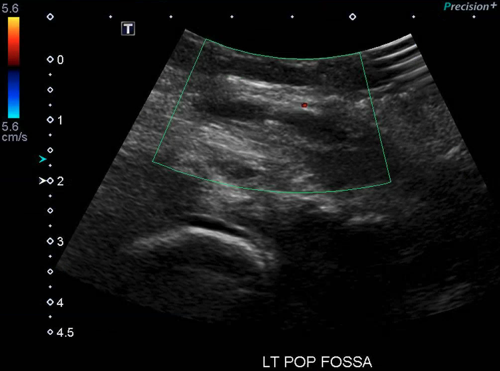 Lower Extremity DVT – Toronto Internal Medicine POCUS