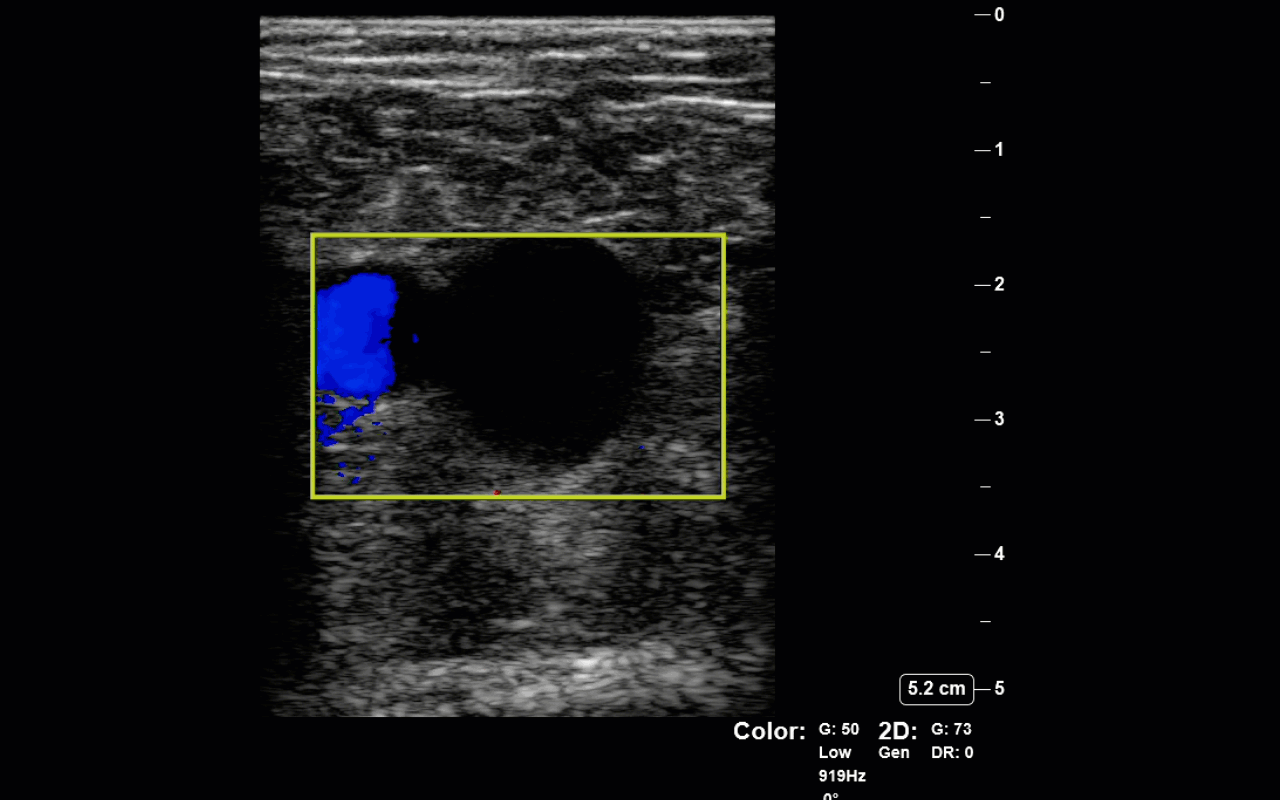 Lower Extremity DVT – Toronto Internal Medicine POCUS