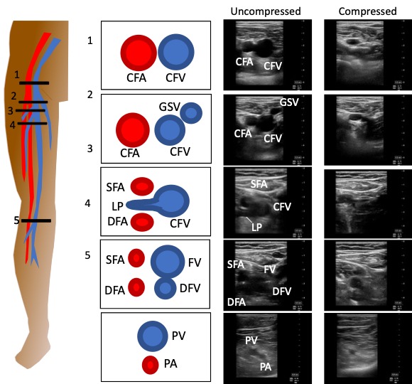 Lower Extremity DVT – Toronto Internal Medicine POCUS