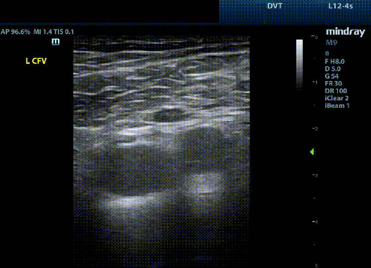 Lower Extremity DVT – Toronto Internal Medicine POCUS