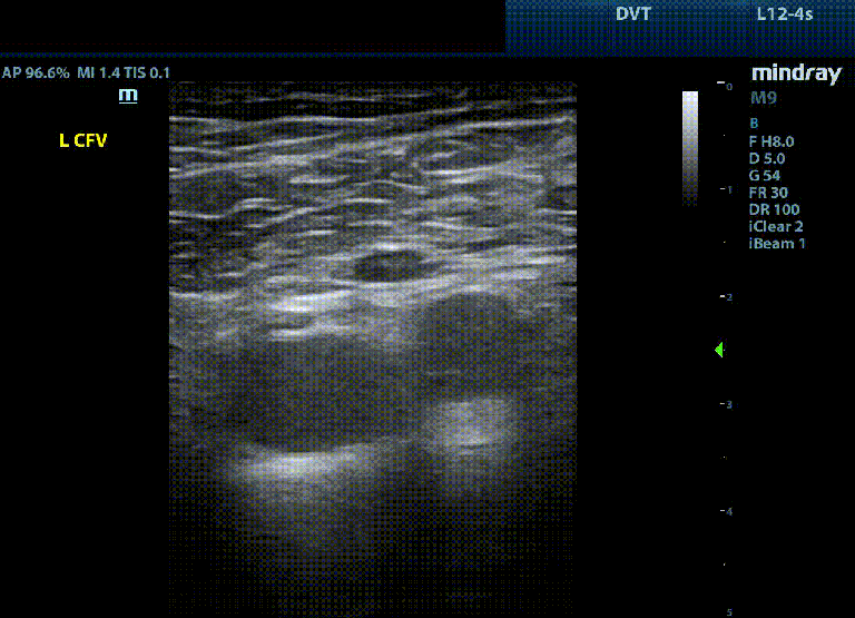 Lower Extremity DVT – Toronto Internal Medicine POCUS