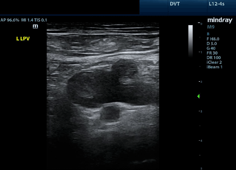 Lower Extremity DVT – Toronto Internal Medicine POCUS