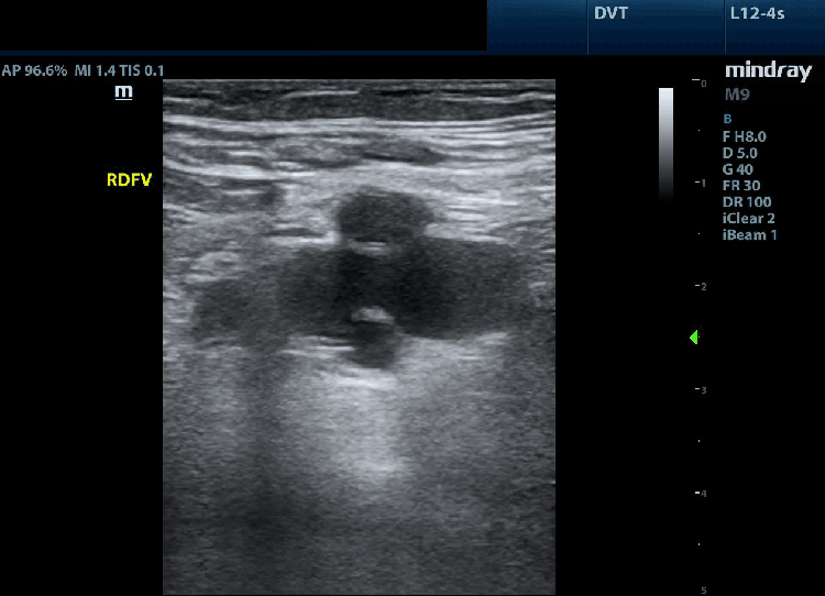 Lower Extremity DVT – Toronto Internal Medicine POCUS