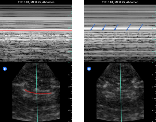 Lung Ultrasound – Toronto Internal Medicine POCUS